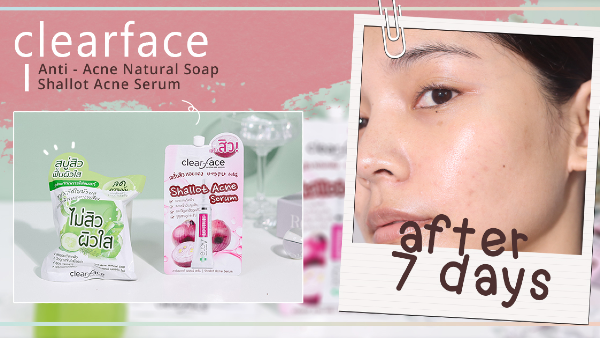 จัดการสิว รอยสิวใน 7 วัน หลักสิบผิวก็ดีขึ้นได้นะ | clearface