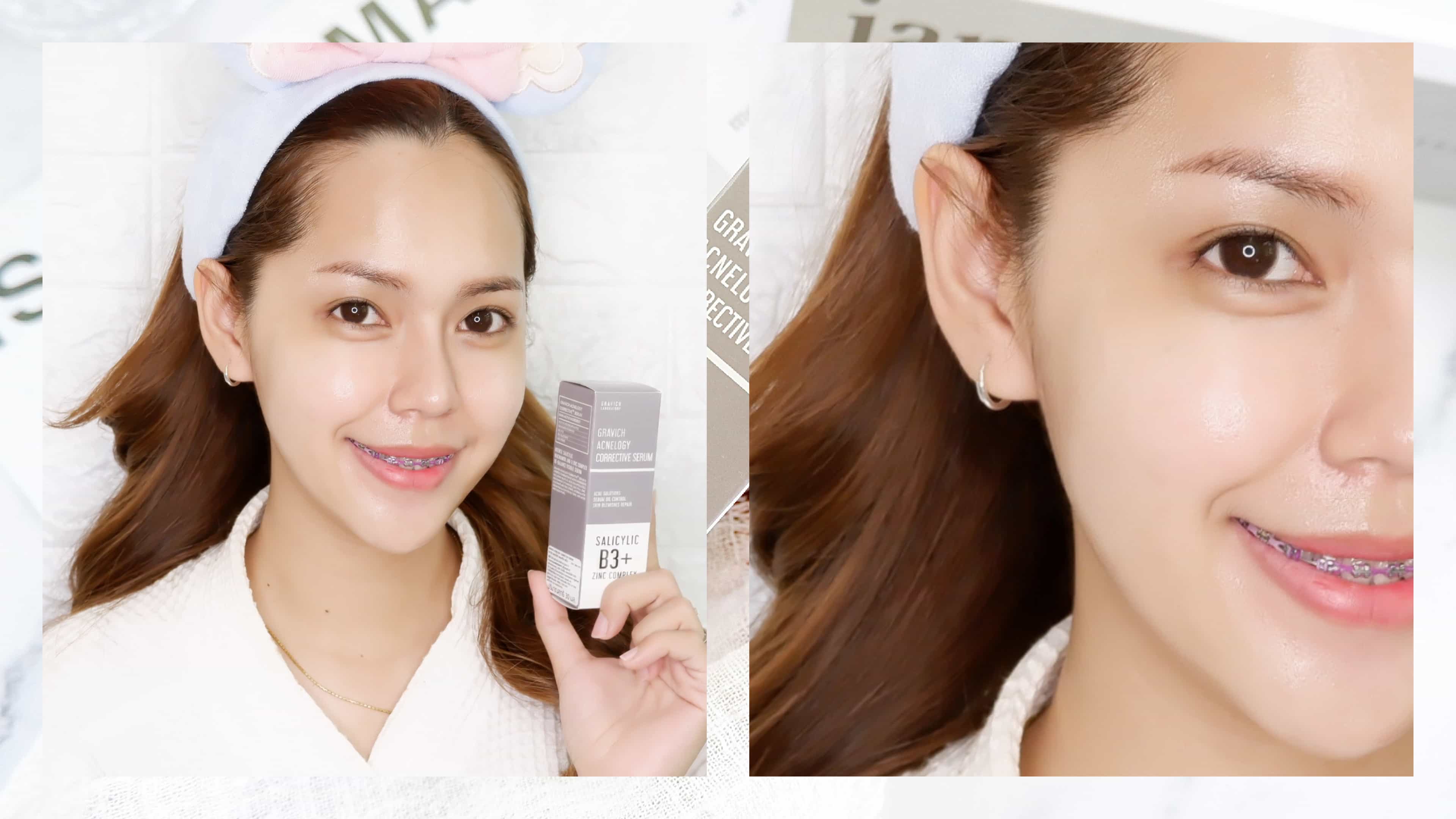 บอกลา “ปัญหาสิว” ด้วย… ACNELOGY CORRECTIVE SERUM