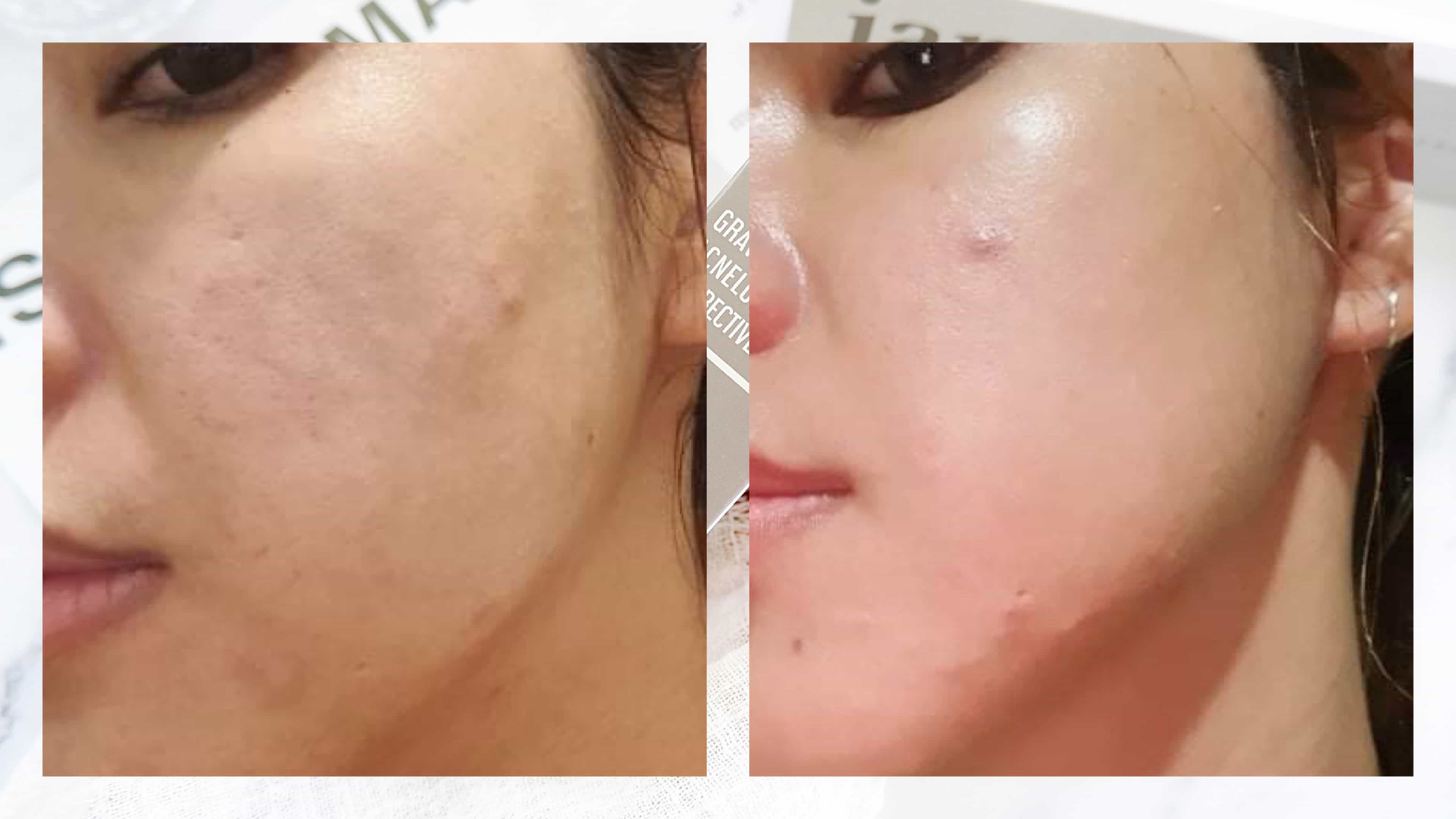 บอกลา “ปัญหาสิว” ด้วย… ACNELOGY CORRECTIVE SERUM